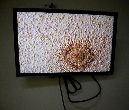 Unruptured Follicle Syndrome - LUF | Famivita