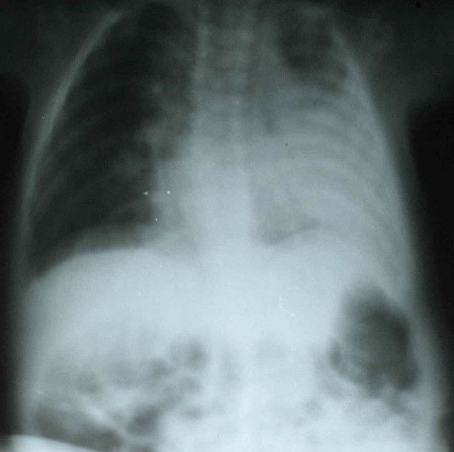 Pneumonia in Children - How to Identify It? | Famivita