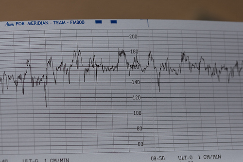 Cardiotocography – Fetal and Uterine Monitoring During Pregnancy