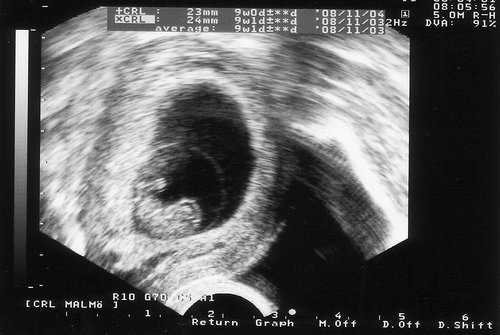 Anembryonic Pregnancy – Why Does It Happen?