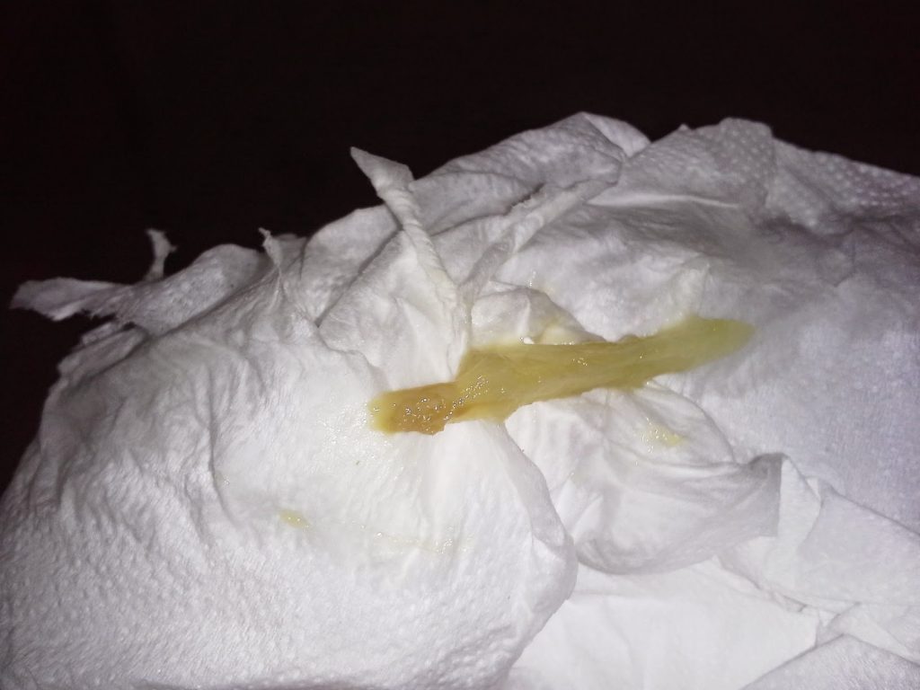 Mucus Plug: What It Is – And How to Identify It