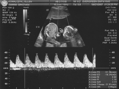 The Importance of Doppler Ultrasound in Pregnancy